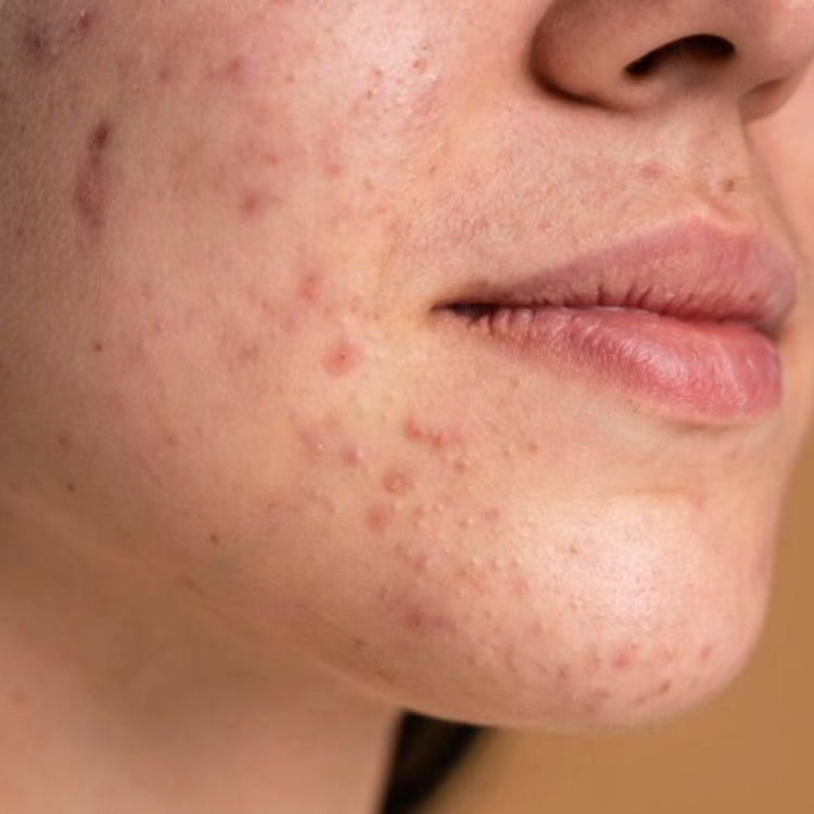Is Your Skin Purging or Breaking Out? – Dr. Whitney Bowe Beauty